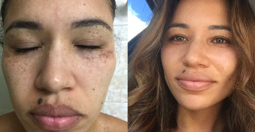 Buy Meladerm® - #1 Rated Dark Spot Correction Cream – Civant